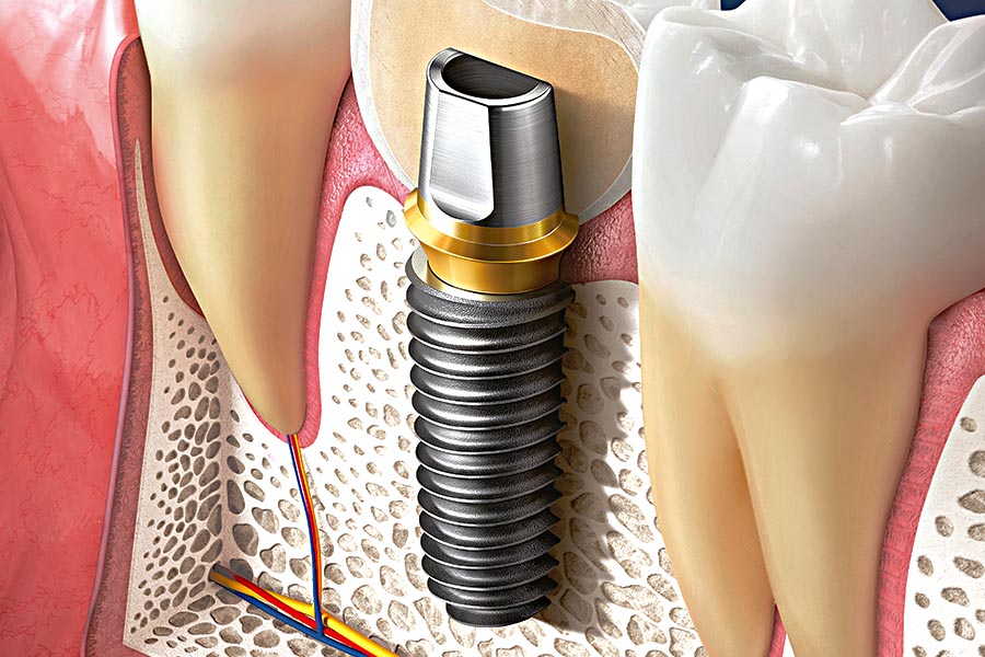 TS Implantsystem – Osstem Implant