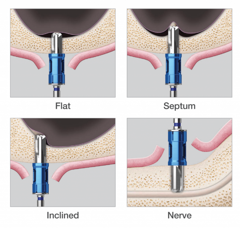 Crestal Approach Sinus Kit | CAS Kit - Osstem Implant